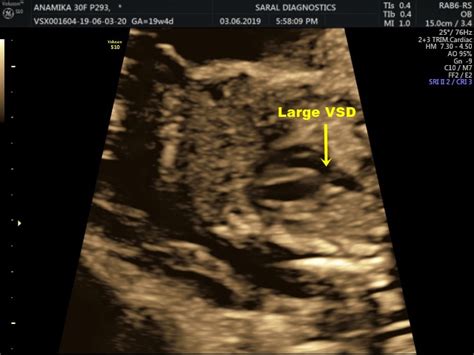 Diagnosed Fetal Heart Diseases Fetal Echo In Delhi