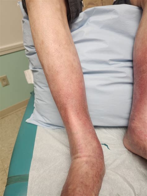 Venous Ulcers Dr Nightingale Clinics In Maine And Vermont