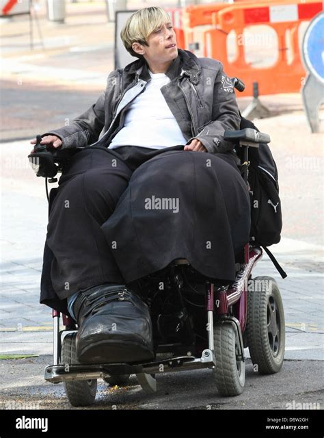 Proteus Syndrome Mandy Sellars