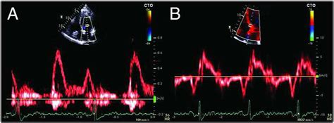 A The Mitral Inflow Pattern Shows A Deceleration Time Of 144 Ms B Download Scientific