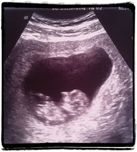 Giving Birth To Dobby Harrypotter