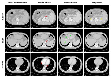 Ct Data Curation For Liver Patients Phase Recognition In Dynamic