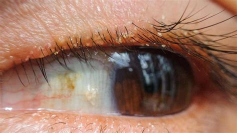 Blefaritis Síntomas Causas Y Tratamientos Para Cuidar Tus Ojos