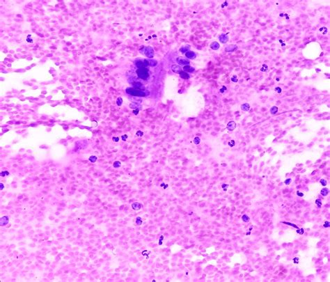160 Histiocitos Fotos Fotografías De Stock Fotos E Imágenes Libres De