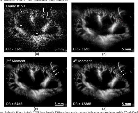 Figure 4 From Super Resolution Ultrasound Imaging Of Vascular Structures With High Temporal