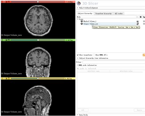 用3d Slicer 对核磁结构影像做降维处理3dslicer中的resample Imagebrain作用 Csdn博客