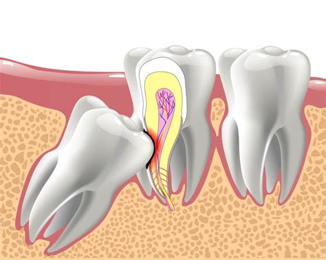 What Are Impacted Teeth