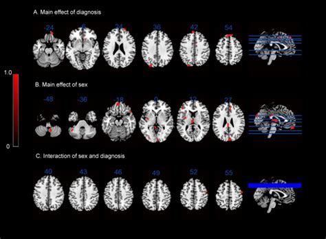 Sex Differences Of Neural Connectivity In Internet Gaming Disorder And Its Association With Sex Differences Of Neural Connectivity In Internet Gaming Disorder And Its Association With