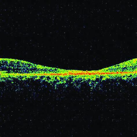 Fundus Photograph Of The Right Eye Showing Hyperpigmentation At The