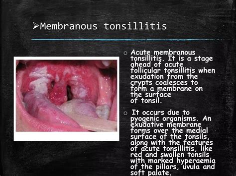 White Patch On The Tonsil Differential Diagnosis Pptx