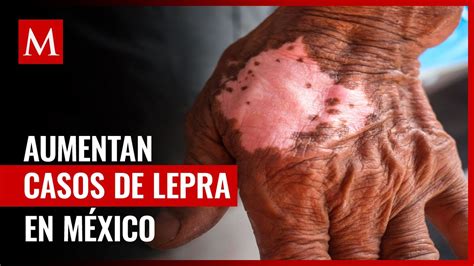 Aumentan Los Contagios De Lepra En México Youtube