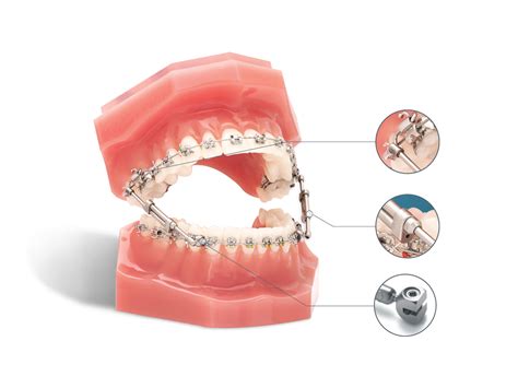 Truease Class Ii Iii Bite Corrector Device Ortho Technology