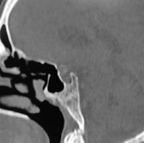 Sagittal Noncontrast Computed Tomography Images Showing Sellar Type Of