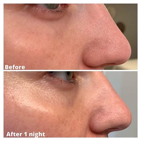 What Is Ammonium Lactate Cream Used For A Multipurpose Skin Care Solution