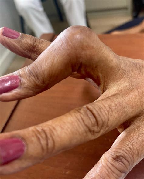 Saludos Y Buenas Tardes 🤙🏽 🏽😎😜 Today We Present A Severe Boutonnière Deformity Corrected With