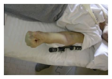 Postoperative Situation Postoperative Radiographs After Grika