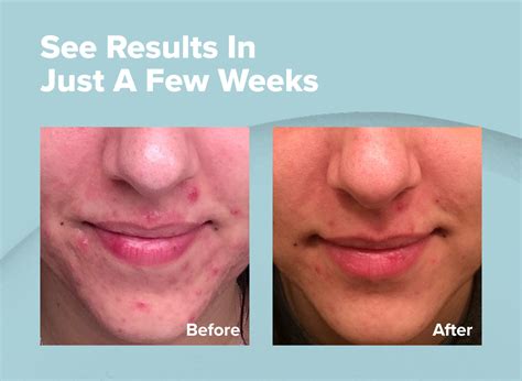 Paulas Choice Clear Acne Pore Normalizing Cleanser Shopee Philippines