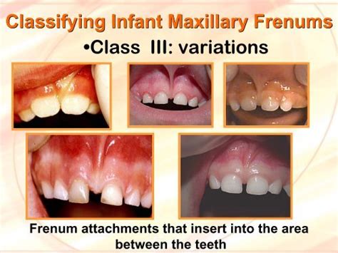 Classifying Infant