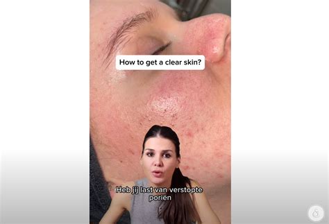 Hoe Krijg Je Een Zuivere Huid Sarasin Clinic