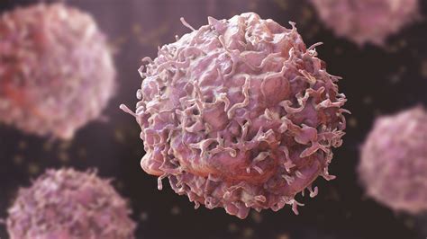 Qué Es El Sarcoma De Ewing El Cáncer Que Sufría Elena Huelva La Joven