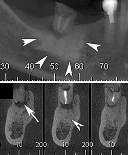 Condensing Osteitis Wikipedia