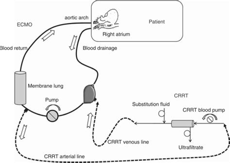 Crrt In Series With Extracorporeal Membrane Oxygenation In Pediatric