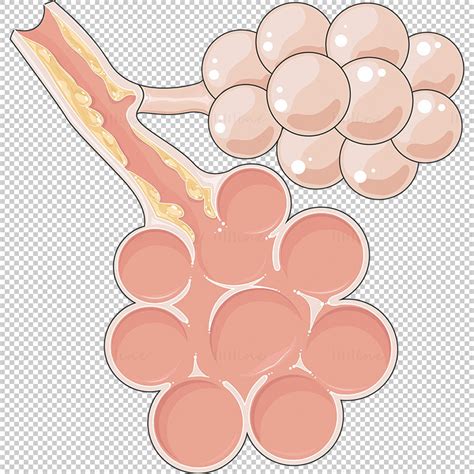 Chronic Bronchitis Vector