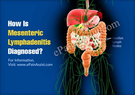 How Is Mesenteric Lymphadenitis Diagnosed