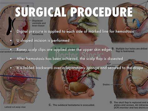 Craniotomy By Nakeeyagoff