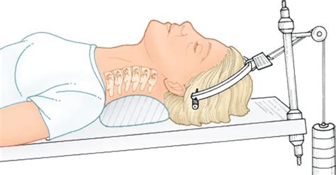 Cervical Facet Dislocations And Fractures Spine Orthobullets