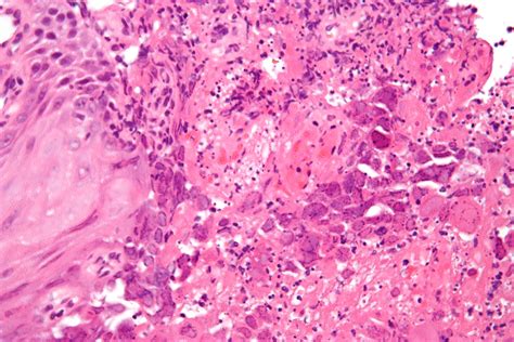 All Types Of Stds And Stis And Their Symptoms Std Blog