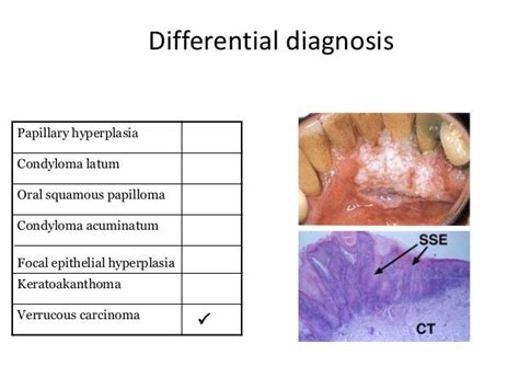 Condyloma Lata Vs Acuminata Genital Warts Yazegz