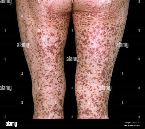 Diffuse Cutaneous Mastocytosis Urticaria Pigmentosa On The Lower