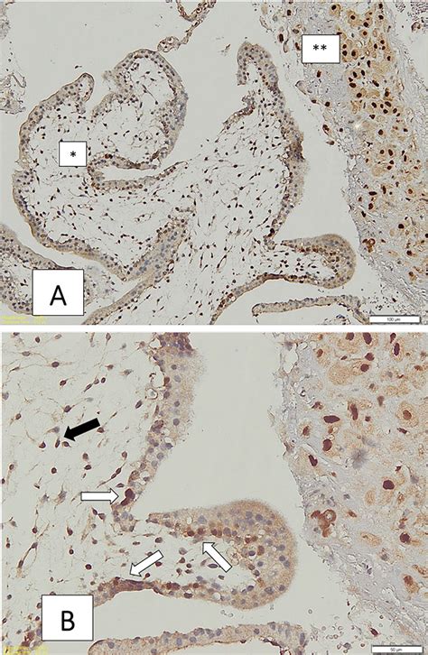 Recurrent Partial Hydatidiform Mole Ijwh
