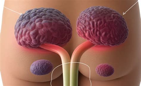 What Do Hemorrhoids Look Like On A Woman Guide