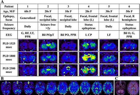 A Six Patients With Epilepsy Showing Hyperperfusion Of Asl In