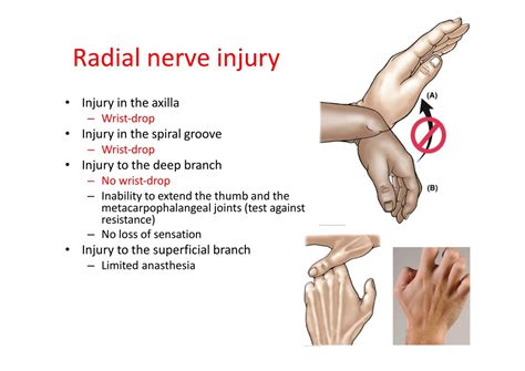 Ppt Comprehensive Guide To Brachial Plexus Anatomy Injuries And Nerve