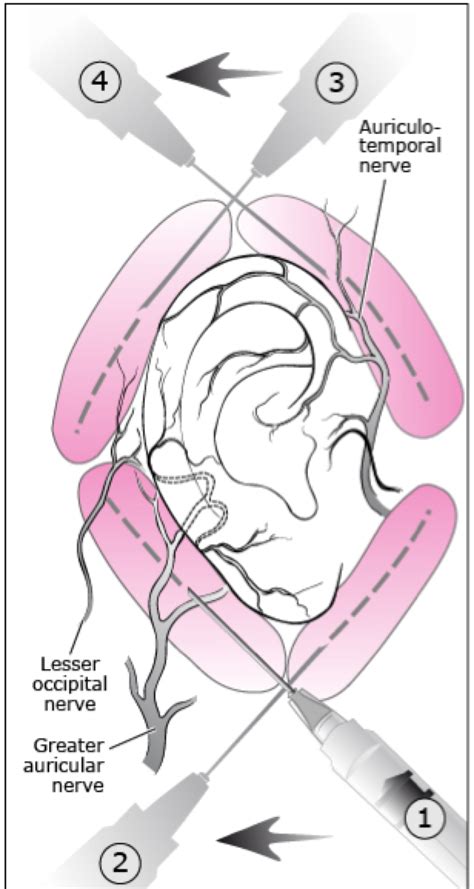 Ear Nerve Field Block