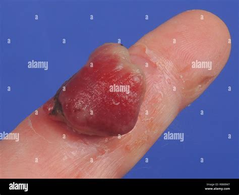 Pyogenic Granuloma Finger