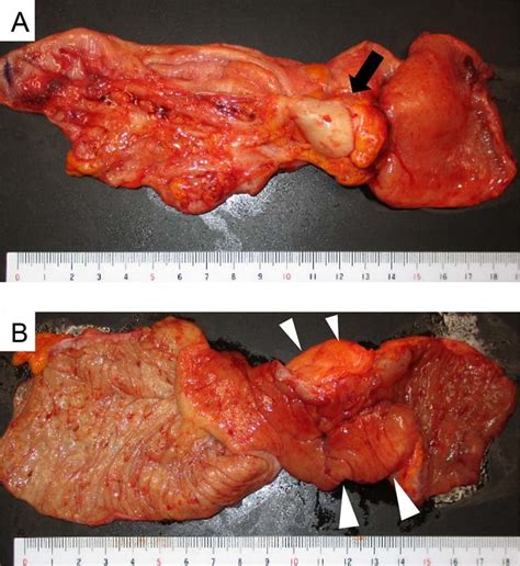 Macroscopic Appearance Of The Ileocecal Resected Specimen A Serosal