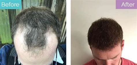 Widows Peak What It Is And How To Get Rid Of It Longevita