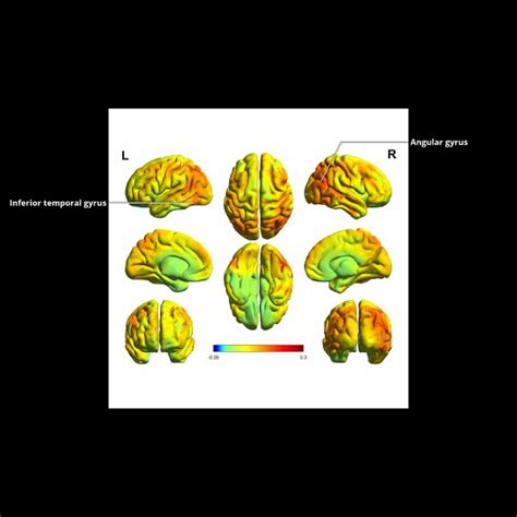 Temporal Cortex Areas 20 21 22 Radiology Key