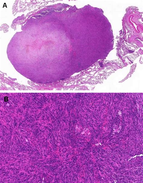 Pulmonary Inflammatory Myofibroblastic Tumour After Hodgkins Lymphoma Bmj Case Reports
