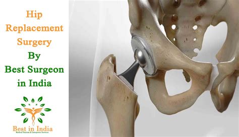 Genital Reconstruction Gender Reassignment Surgery In India