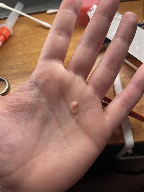 Not A Tonsil Stone Literally A Piece Of White Blood Cells That Fell Of