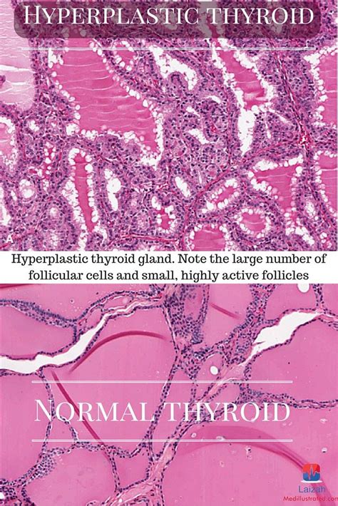 Hyperplasia Of Thyroid Gland