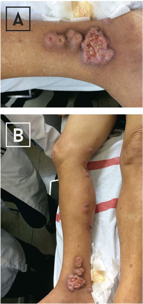 Nodular Lymphangitis Syndrome Pmc