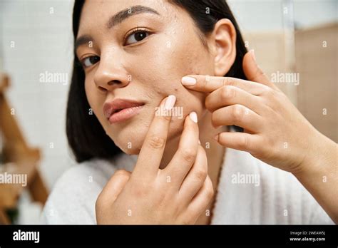 Brunette And Young Asian Woman In Bath Robe Popping Pimple On Her Face Skin Issues Or Real