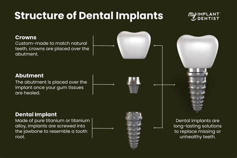Complete Guide To Dental Implants In Perth My Implant Dentist