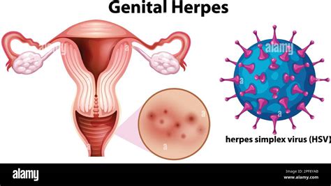 Genital Herpes With Herpes Simplex Virus Hsv Illustration Stock Vector Image And Art Alamy
